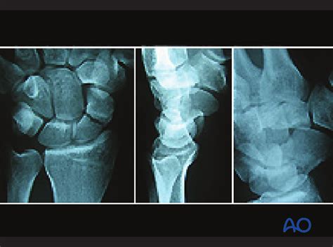 Scaphoid Proximal Pole