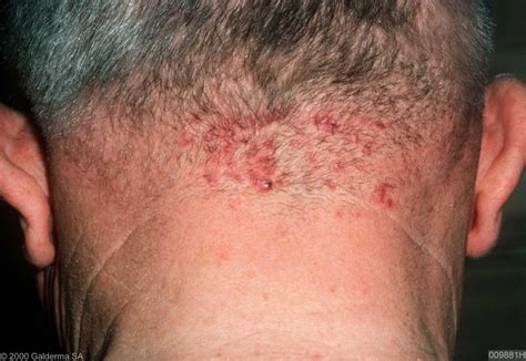 Acne Keloidalis Nuchae Pictures Photos