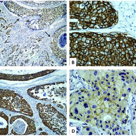 A High Grade Ductal Carcinoma In Situ Associated With Invasive Mammary