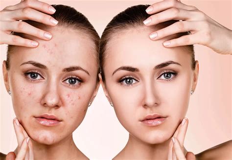 Acne Scars Causes And Treatment In Hyderabad