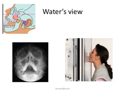 Extra Oral Radiograph