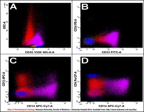 Acute Monoblastic Monocytic Leukaemia Cell Atlas Of Haematological