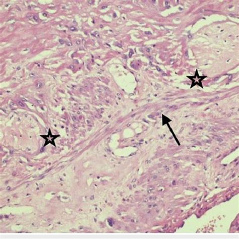 Microphotograph Of Placenta Increta Showing Hyalinised Chorionic Villi