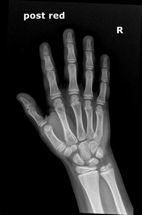 A Dislocated Thumb At Mark Bateman Blog