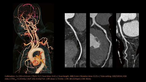 Ct Scanner Somatom Force Siemens Healthineers