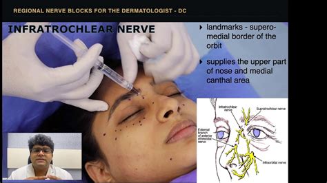 Infraorbital Nerve Block Landmarks