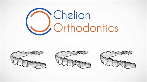 Invisalign Explained In 30 Seconds Youtube