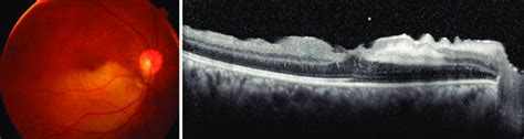 A Color Fundus Photograph Showing A Chorioretinal Scar At The Impact Download Scientific
