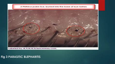 Seminar On Blepharitis Meibomitis Pptx Doc Ppt