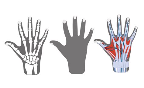 Curing Clenched Fist Syndrome Telegraph
