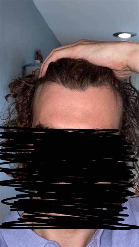 Receding Or Maturing Hairline Rhairloss