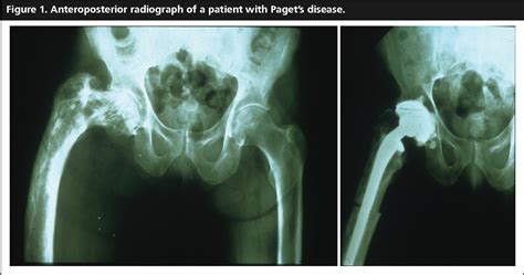 Figure 1 From Pagets Disease Of The Hip Surgical Management