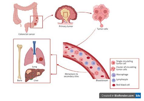 Figure 1 From Circulating Tumor Cells In Colorectal Cancer A Review
