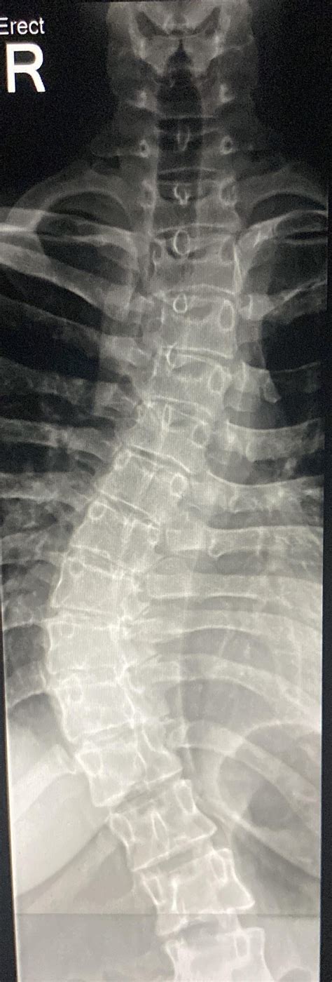 Pregnancy With Scoliosis Advice Rscoliosis