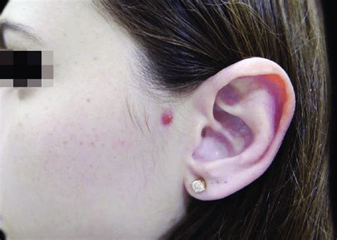 Erythematous Papule 7mm In Diameter In The Left Preauricular Region