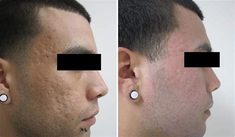 Acne Scar Treatment Los Angeles Acne Scar Removal Dr Behnam
