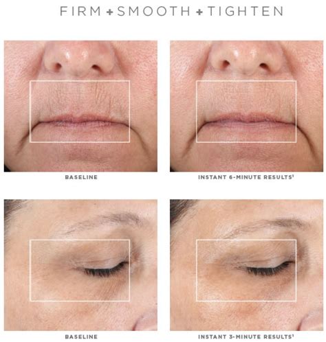 Nuface Fix Line Smoothing Device