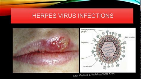 Oral Herpes Virus Infection Part 1 Youtube