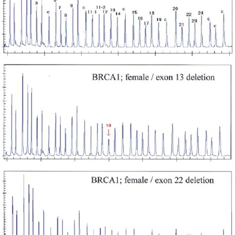 Detection Of Brca1 Exon Deletions By Mlpa Samples Containing ∼100 Ng