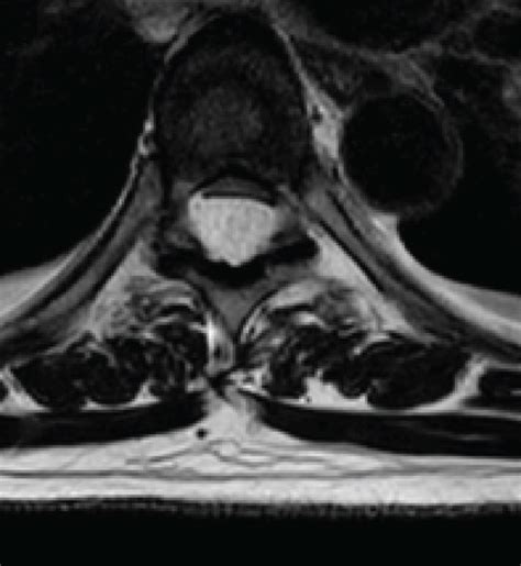 Preoperative Thoracic Mri A Heterogeneous Epidural Posterior Mass