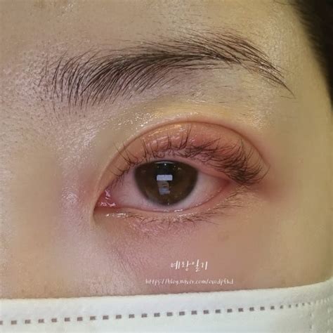 눈 다래끼 치료 후기 3~5일차 스테로이드성 항염증제 소염제 주사 붓기 증상 네이버 블로그