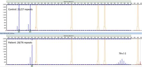 Cag Repeat Analysis Of Patient Iii13 Of Case 2 Showed One Expanded