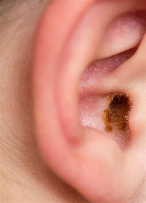Ear Wax Removal Easi Ear Hearing Care