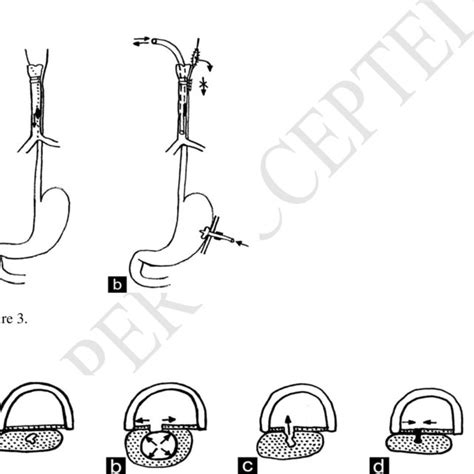PDF Surgical Treatment Of Acquired Tracheoesophageal Fistula Caused