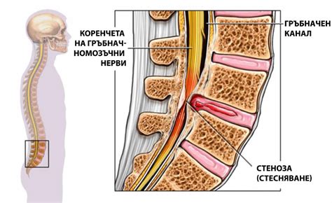 Стеснение на гръбнaчен канал Спинална стеноза Physiofix Bg