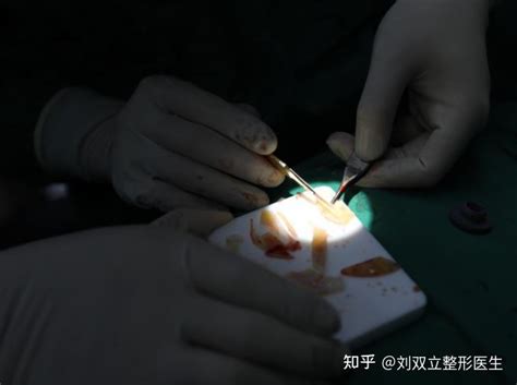 自体软骨隆鼻有什么优势？自体软骨隆鼻怎么样 知乎