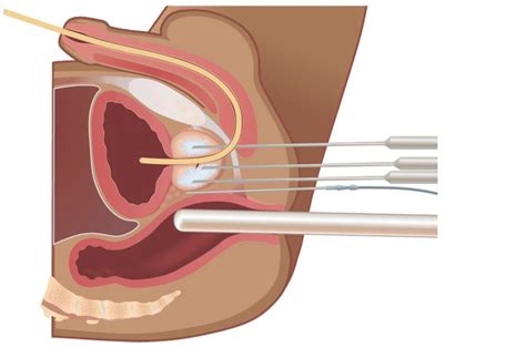 Mri Fusion Guided Tp Prostate Biopsy Southern Westchester Urology