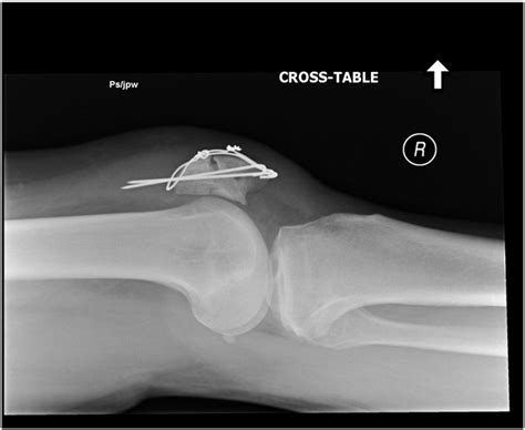Tension Band Wiring Patella Procedure