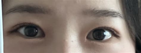 자연유착 눈매교정 앞트임 시술 받았어요 리얼후기 눈이 예쁘다 그래서 아몬드성형외과