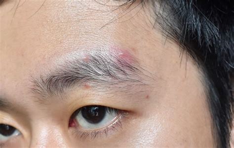 Pimples Around Eyebrows