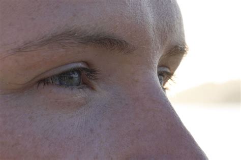 Médicos Alertam Sobre Riscos Para Saúde Dos Olhos Durante Carnaval