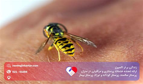 درمان نیش زنبور برای ورم نیش زنبوری چه کنیم؟