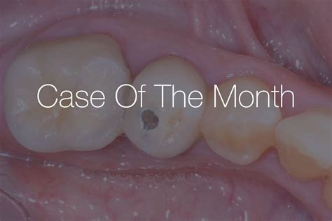 Socket Preservation With Maxresorb® And Mucoderm® Botiss Biomaterials