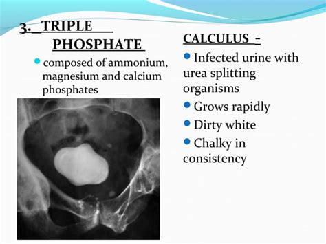 Bladder Calculi Ppt