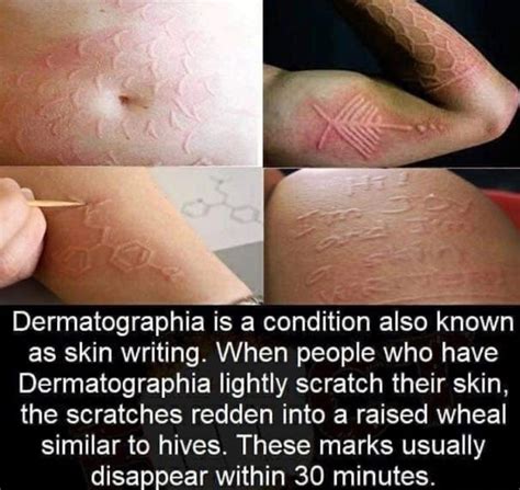 Dr Sana Sarwar On Linkedin Dermatographia