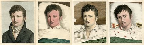 Politics of Yellow Fever in Alexander Hamilton's America