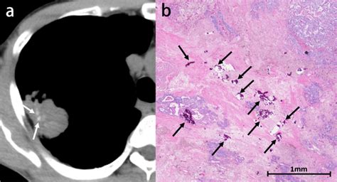 Stepwise Diagnostic Algorithm For High Attenuation Pulmonary Abnormalities On Ct Pmc