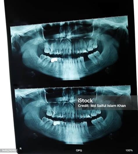 Rontgen Gigi Ortopantomografi Atau Opg Foto Stok Unduh Gambar