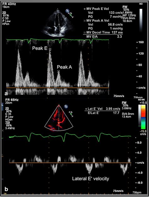 Transthoracic Spectral Doppler Echocardiography At The Mitral Valve