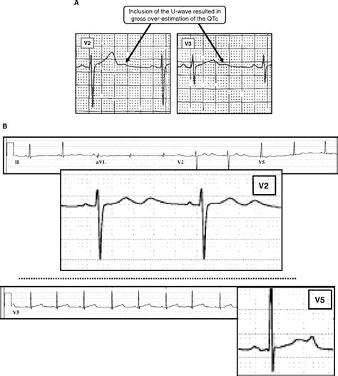 Diagnostic Miscues In Congenital Long QT Syndrome Circulation