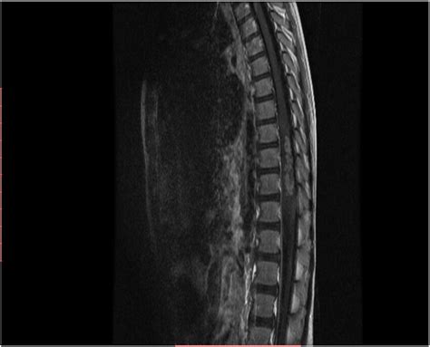 Post Contrast Sagittal Image With Intramedullary Enhancing Lesions