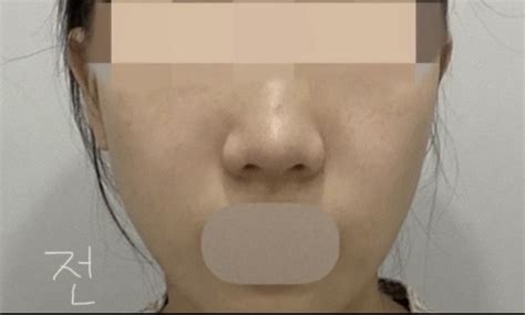 발품후기 위버스성형외과 서승 강남언니 1등 성형수술and피부시술 정보앱