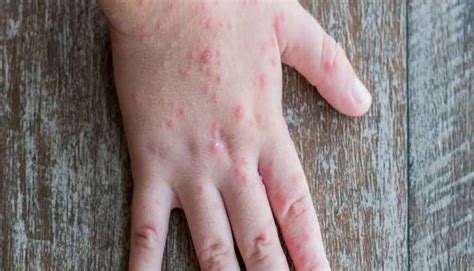 Lancet Study Tomato Flu Spreading In India Know Symptoms And Treatment