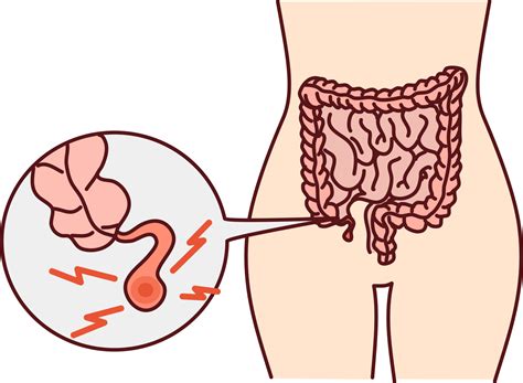 Human Body With Inflamed Appendicitis 21248592 Png