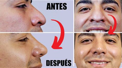 RinoplastÍa En Hombres 👃🏼 Antes Y Después De La Rino 👃🏼 Un Cambio De