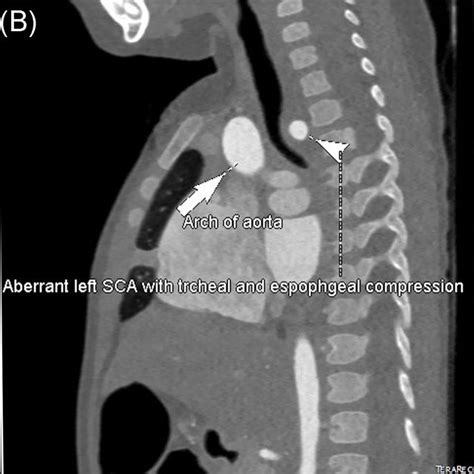 Computer Tomography Ct A Ct Reconstruction Of Vascular Ring